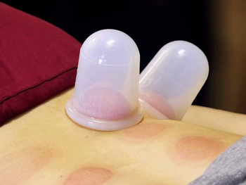 What is Cupping Therapy: Benefits, Types & What to Expect